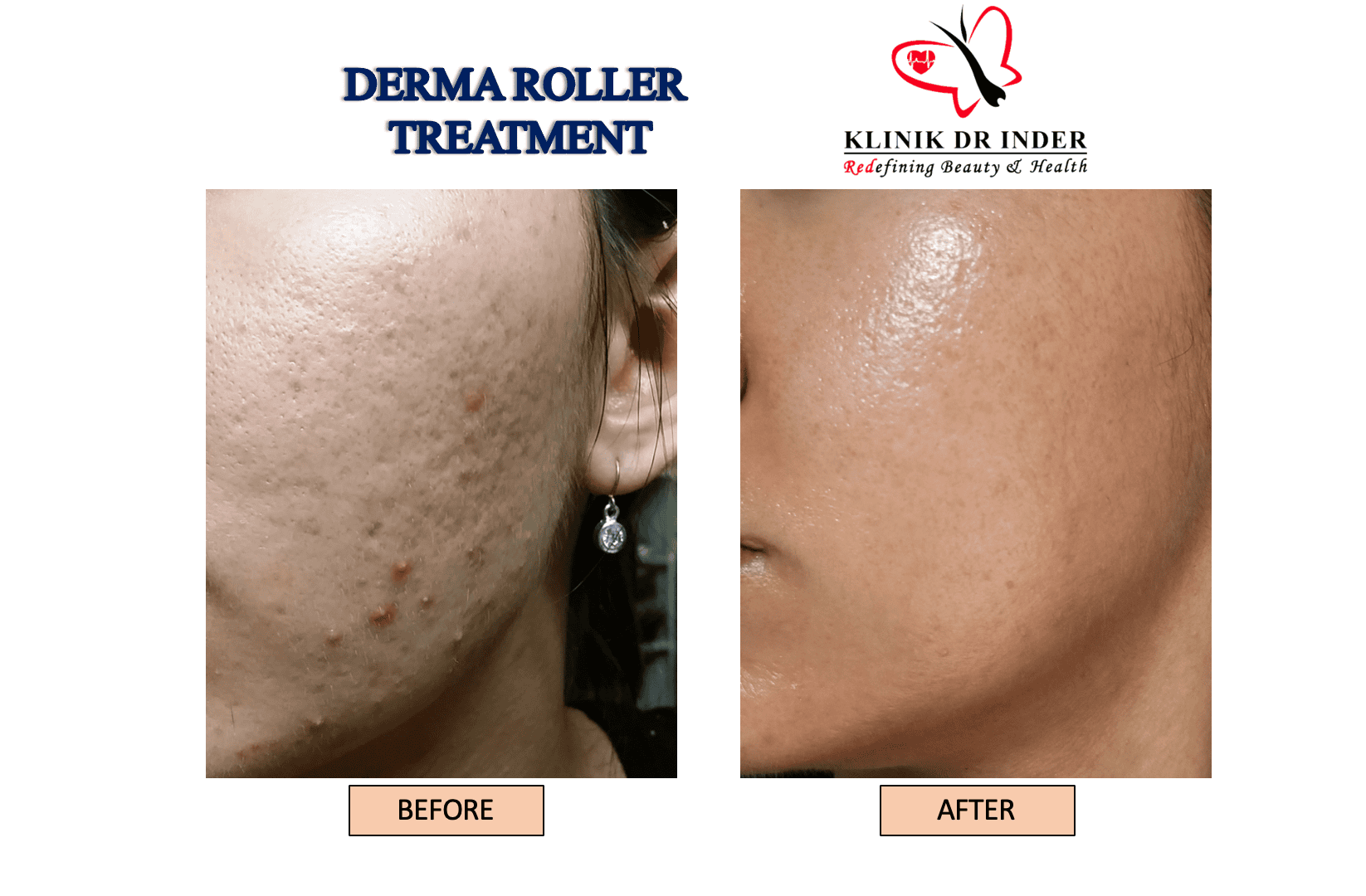 Derma Roller - Skin Treatment - Aesthetic Clinic Malaysia - Klinik Dr Inder Derma Roller - Skin Treatment - Aesthetic Clinic Malaysia - Klinik Dr Inder