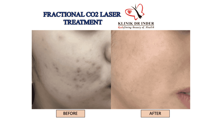 Fractional Co2 Laser - Scars Removal - Laser Treatment - Aesthetic Clinic