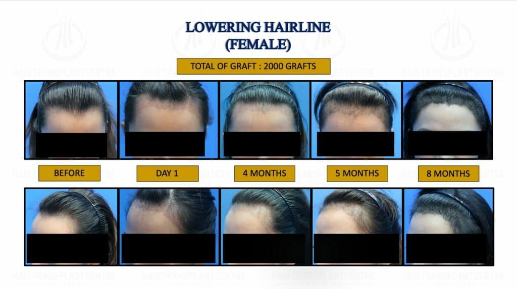 Lowering Hair Line - Hair Treatment - Klinik Dr Inder - FUE Hair Transplant