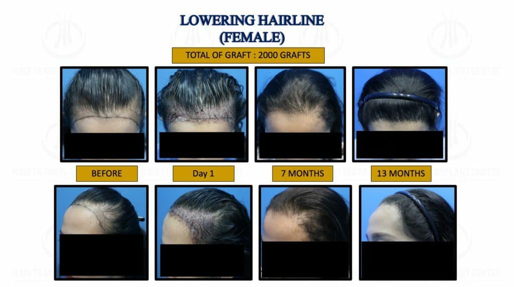 Lowering Hair Line - Hair Treatment - Klinik Dr Inder - FUE Hair Transplant