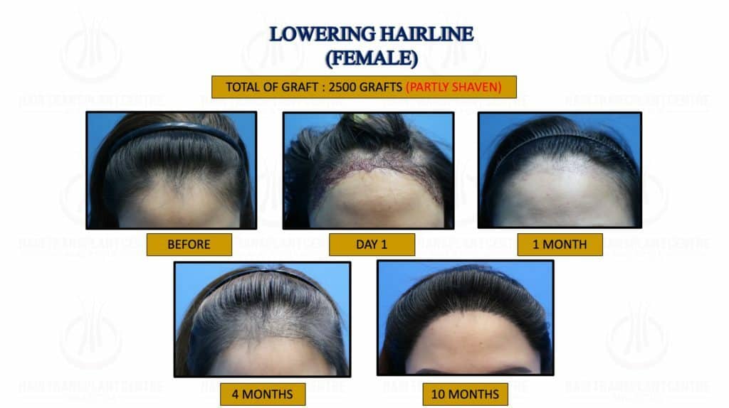 Lowering Hair Line - Hair Treatment - Klinik Dr Inder - FUE Hair Transplant
