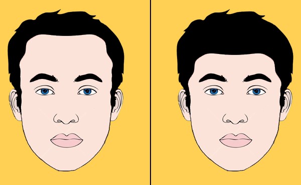 Lowering Hair Line - Hair Treatment - Klinik Dr Inder - FUE Hair Transplant
