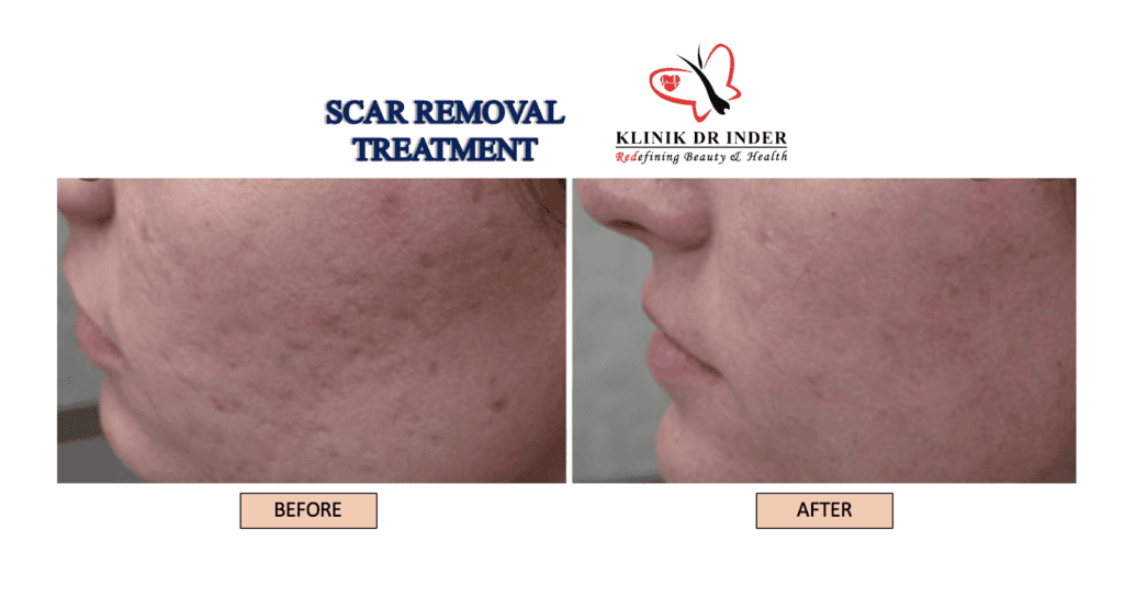Laser Scar Removal - Scar Removal Treatment - Aesthetic Clinic