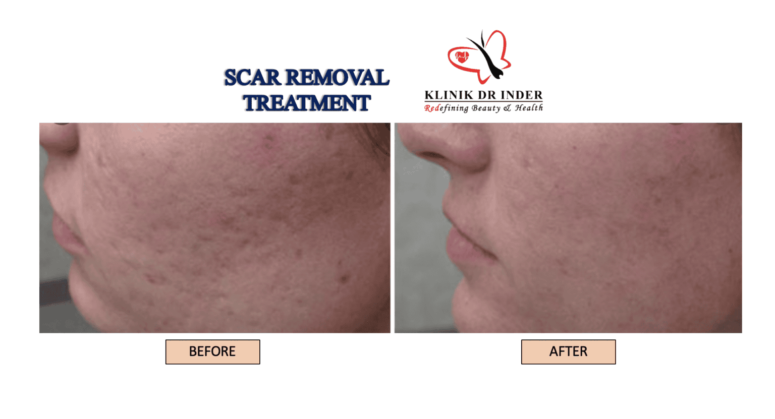 Laser Scar Removal - Scar Removal Treatment - Aesthetic Clinic