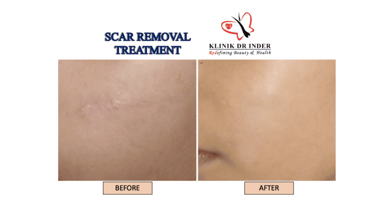 Laser Scar Removal - Scar Removal Treatment - Aesthetic Clinic