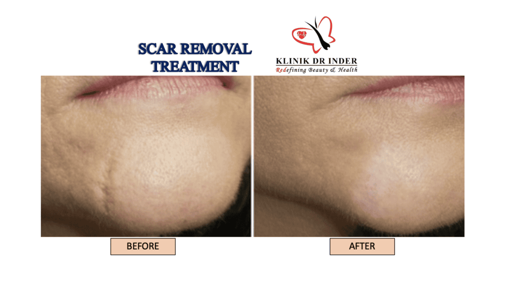Laser Scar Removal - Scar Removal Treatment - Aesthetic Clinic