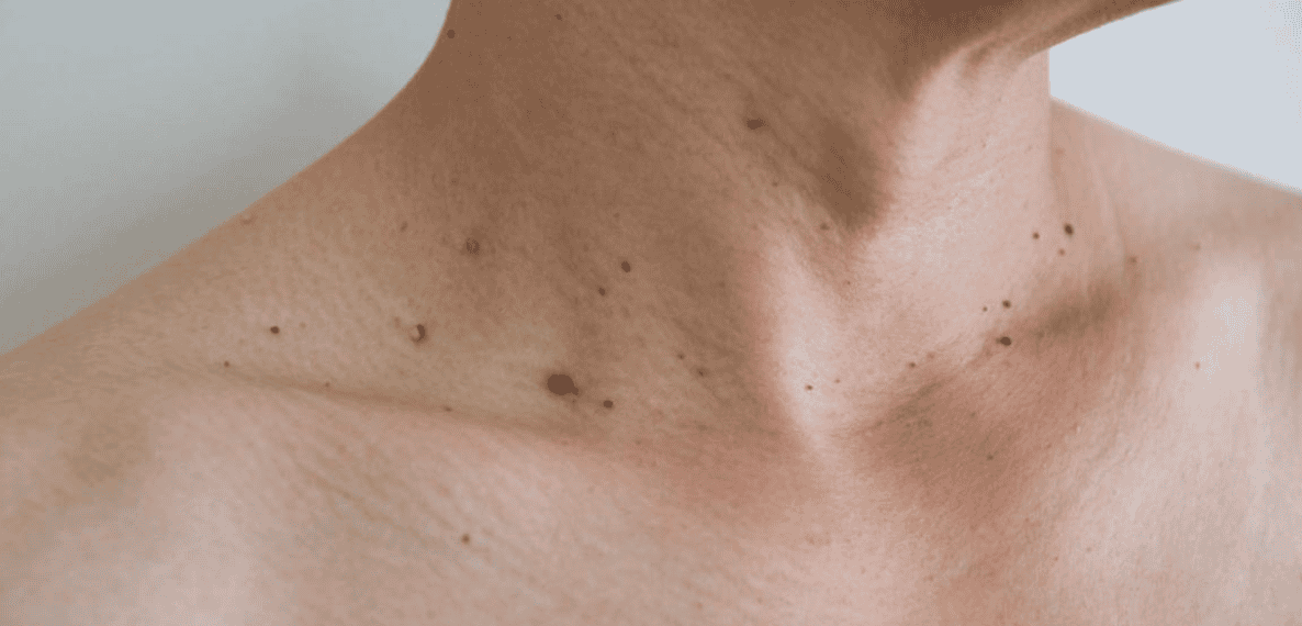 Skin Tag Treatment - Aesthetic Clinic Malaysia - Klinik Dr Inder