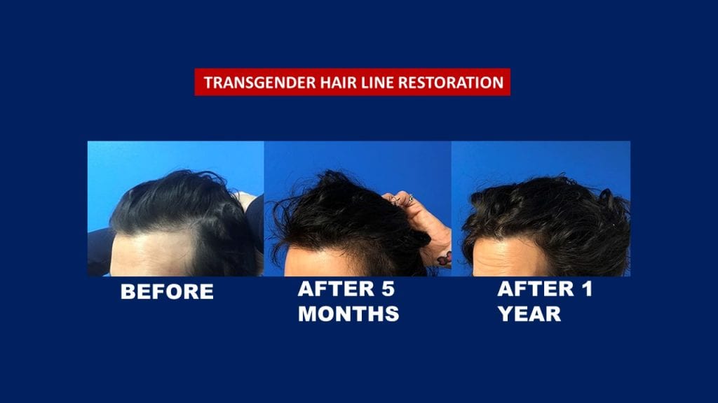 Transgender Hair Transplant - FUE Techniques - Guaranteed Results