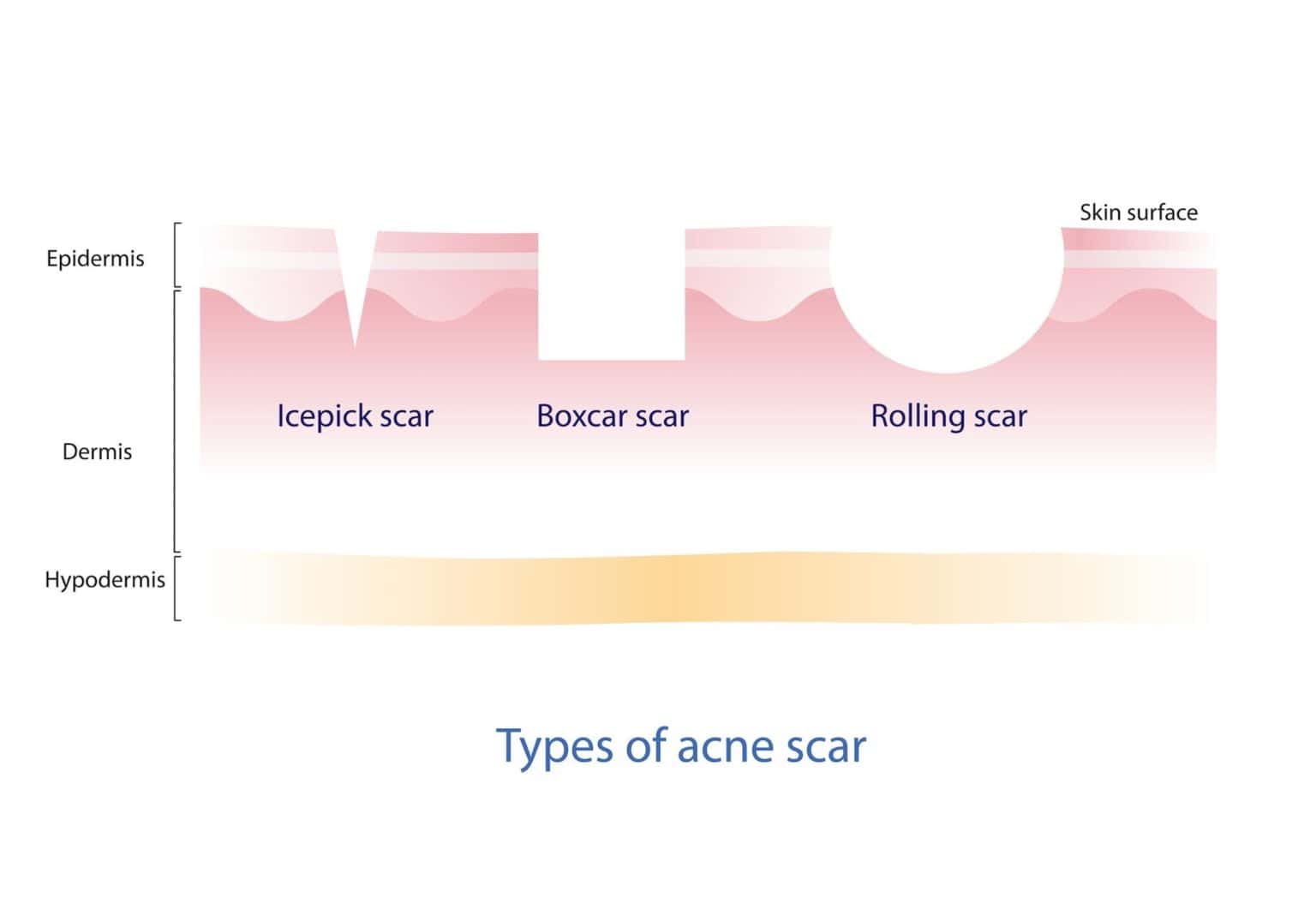 Laser Scar Removal - Scar Removal Treatment - Aesthetic Clinic