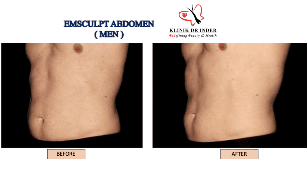 Emsculpt - No 1 Treatment For Build Muscle - Aesthetic Clinic Malaysia