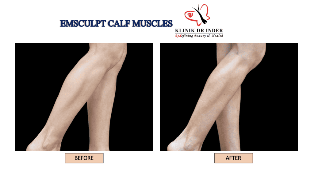 Emsculpt - No 1 Treatment For Build Muscle - Aesthetic Clinic Malaysia