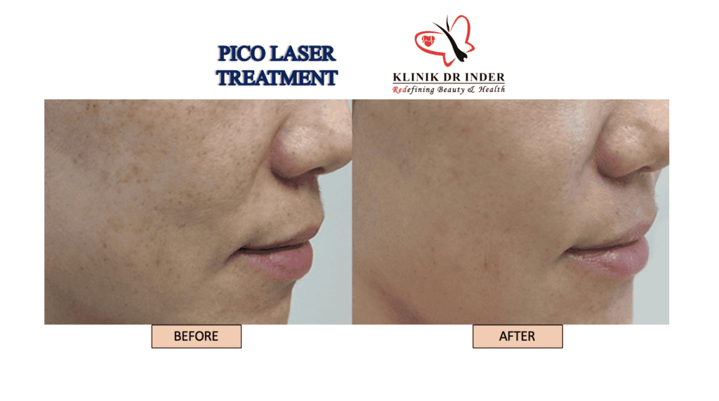 Laser Depigmentation 2 - Klinik Dr Inder