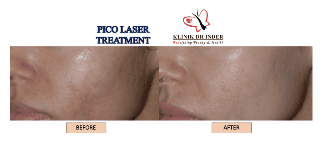 Laser Depigmentation 2 - Klinik Dr Inder