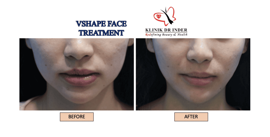 V Shape Face - Klinik Dr Inder