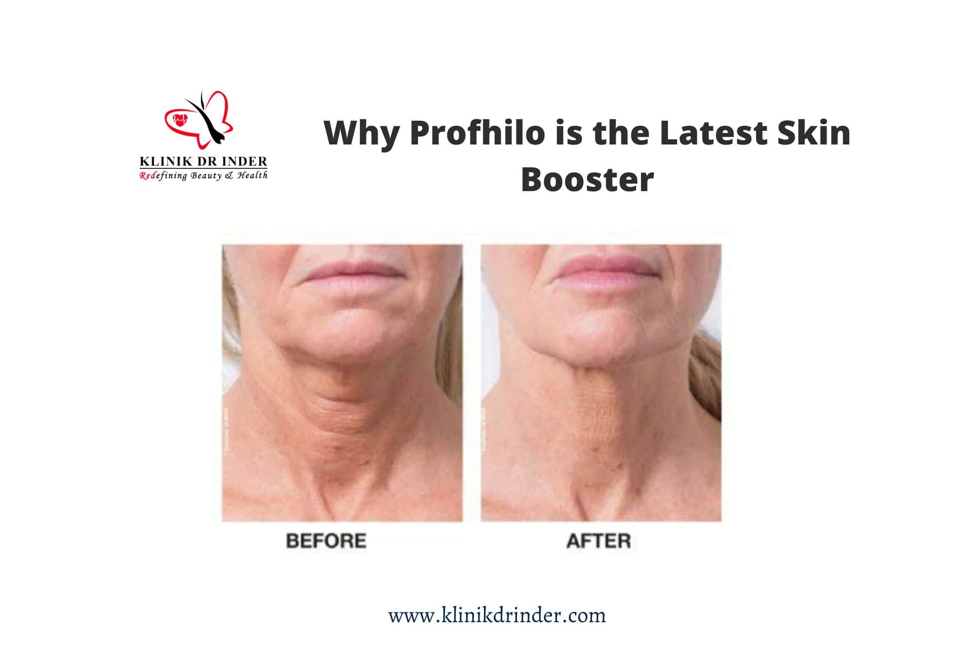 Why Profhilo is the Latest Skin Booster - Klinik Dr Inder