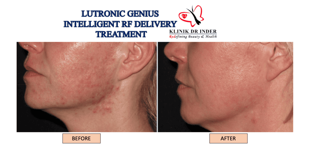 The New Lutronic Genius RF Microneedling is Finally Here!