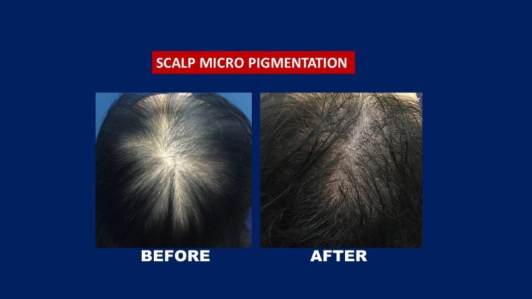 Scalp Micro Pigmentation - Hair Treatment - Hair Growth Treatment