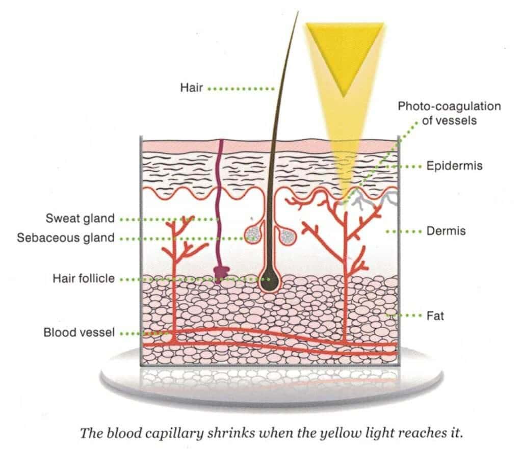Dual Yellow Laser - Klinik Dr Inder