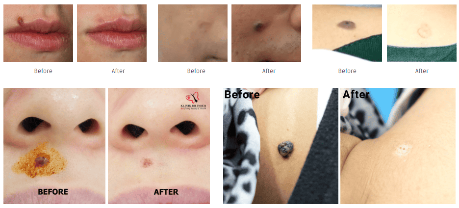 Mole Removal Treatment - No Scar & Minimal Pain - Effective Procedure.
