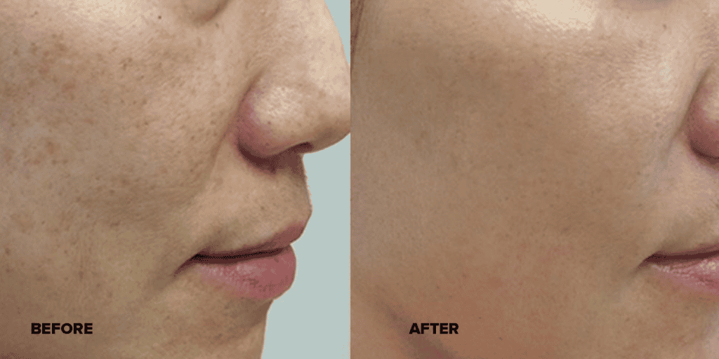 Pico Laser - Laser Treatment - Skin Imperfections - Aesthetic Clinic