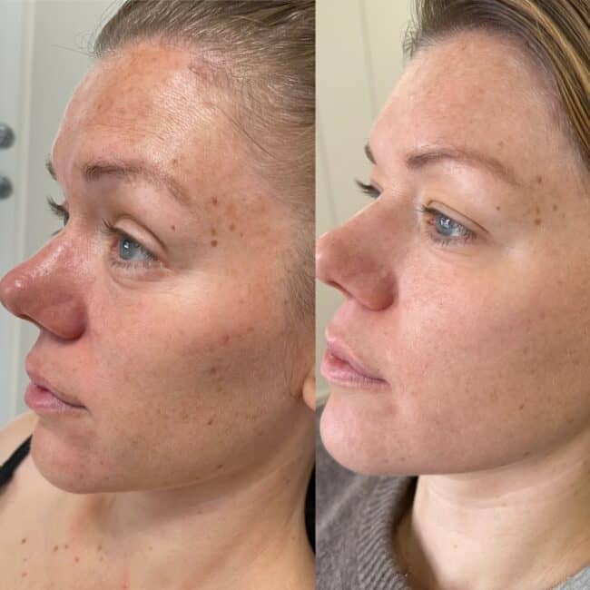 LaseMD Laser - Klinik Dr Inder