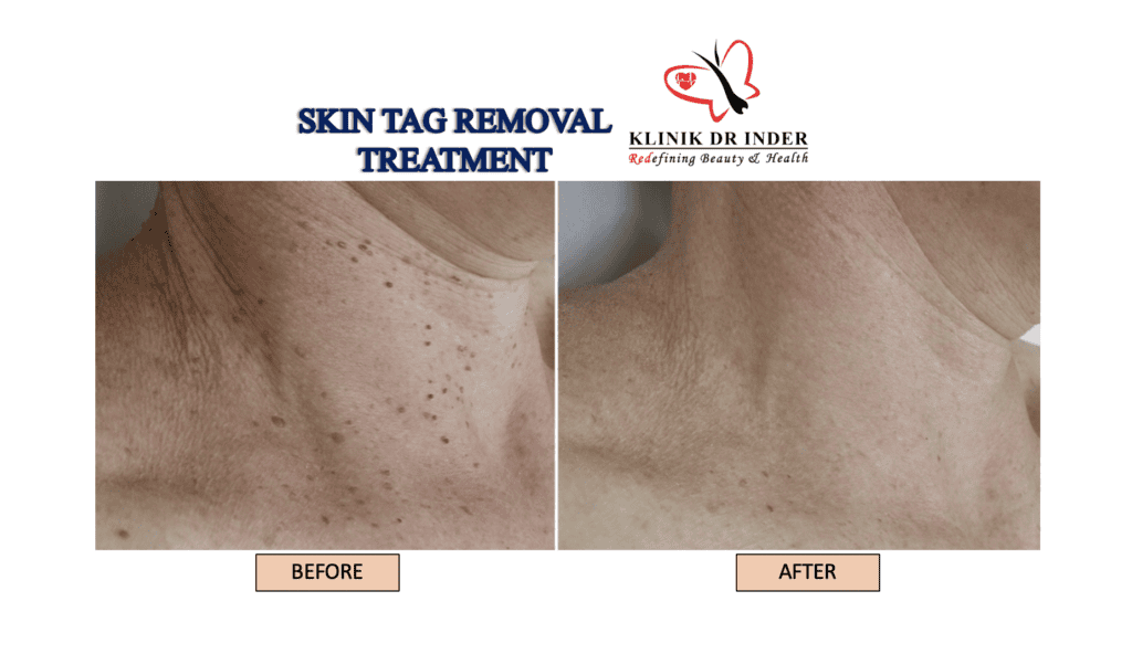 How Do I Treat & Prevent Skin Tags? - Klinik Dr Inder